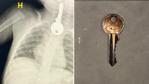 Child swallows key, X-ray reveals
