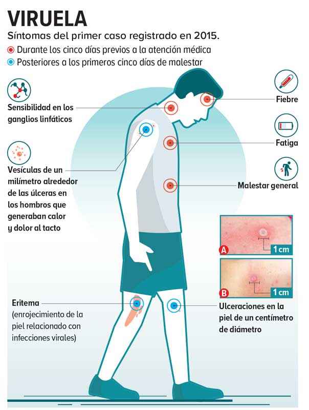 Alaska smallpox triggers emergency; first death